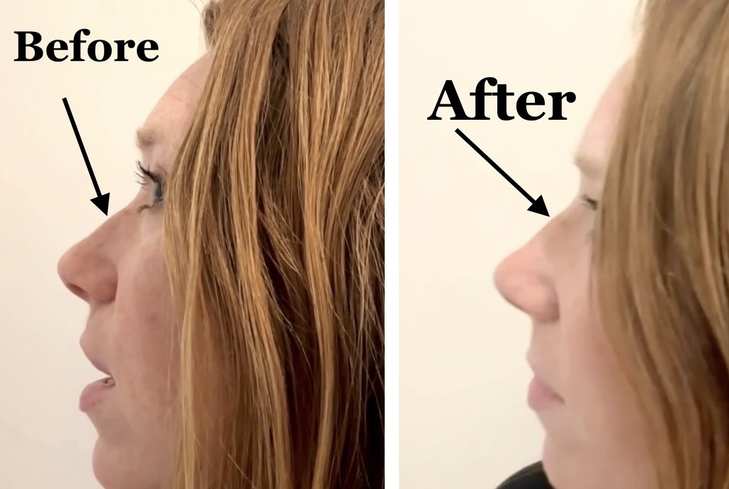Septoplasty: Before & After – DIFER.ORG
